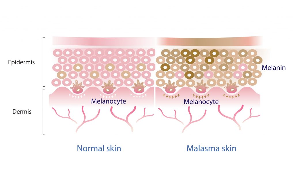 Leading Melasma Treatment Bellevue & Kirkland