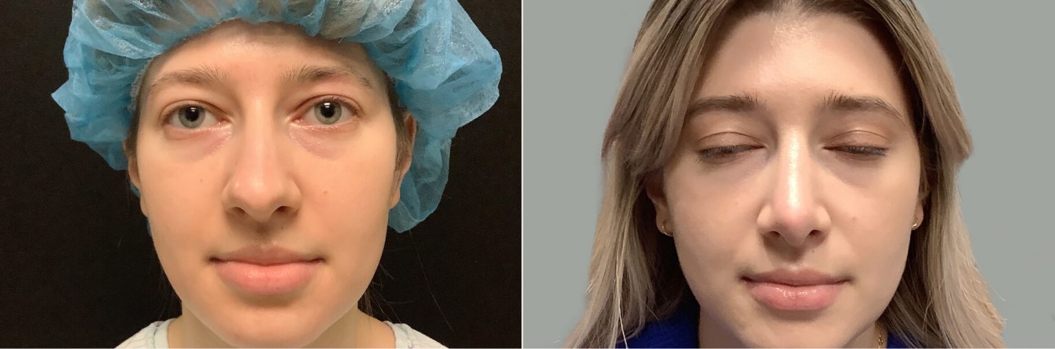 Best Ultrasonic Piezo Rhinoplasty in Bellevue & Kirkland