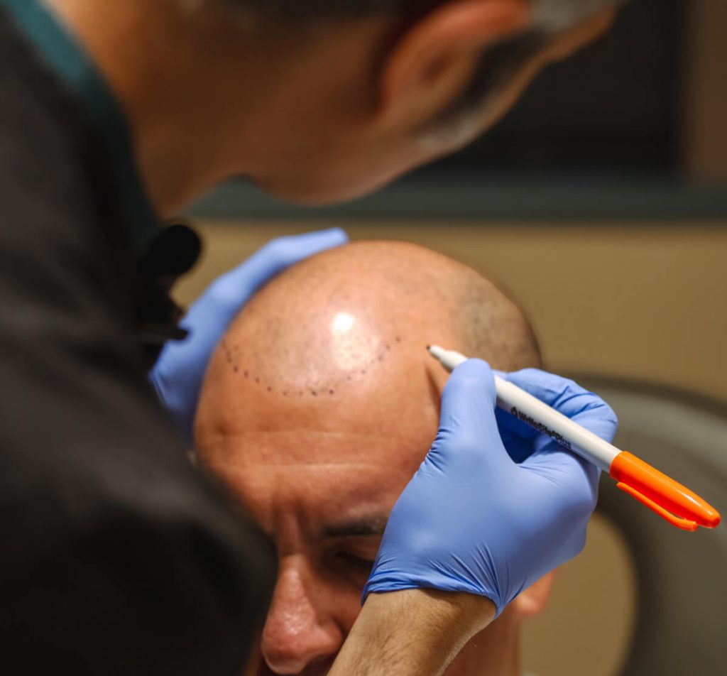 Advanced Hairline Transplant in Bellevue & Kirkland