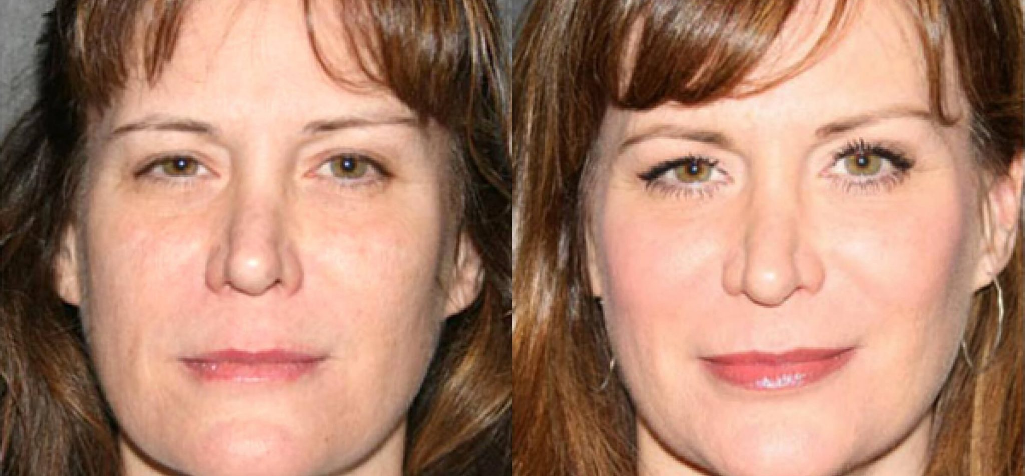 Facial Fat Transfer in Bellevue & Kirkland by Dr. Khezri