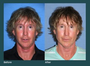 Mandibular Implants by Dr. Young in Kirkland & Lynnwood