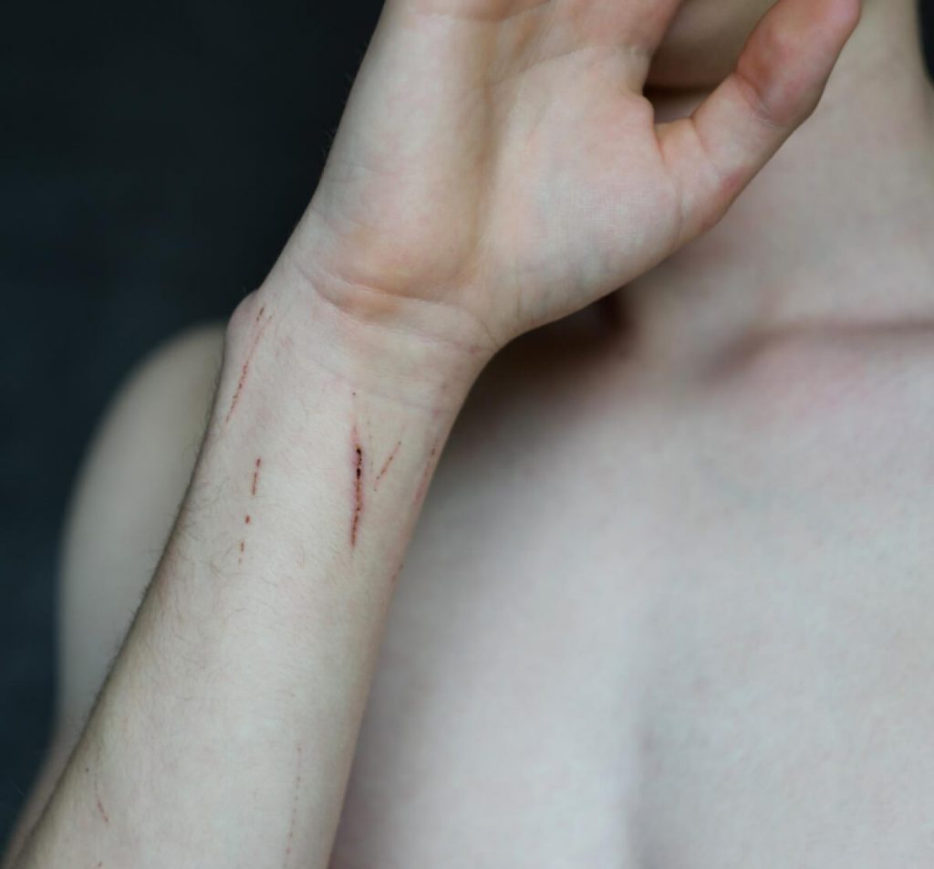 Self-Harm Scar Treatment in Seattle by Dr. Philip Young Self-Harm Scar Treatment in Seattle by Dr. Philip Young
