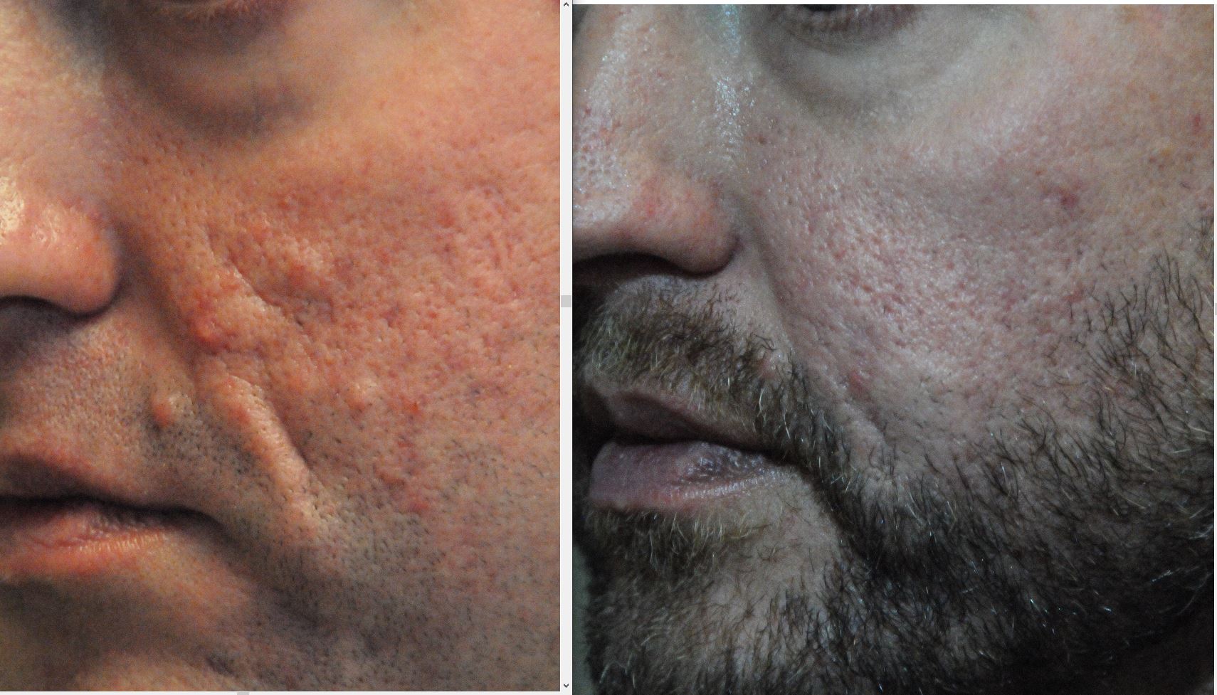 Acne Scar Vitalizer | Skin & Acne Treatment by Dr. Young
