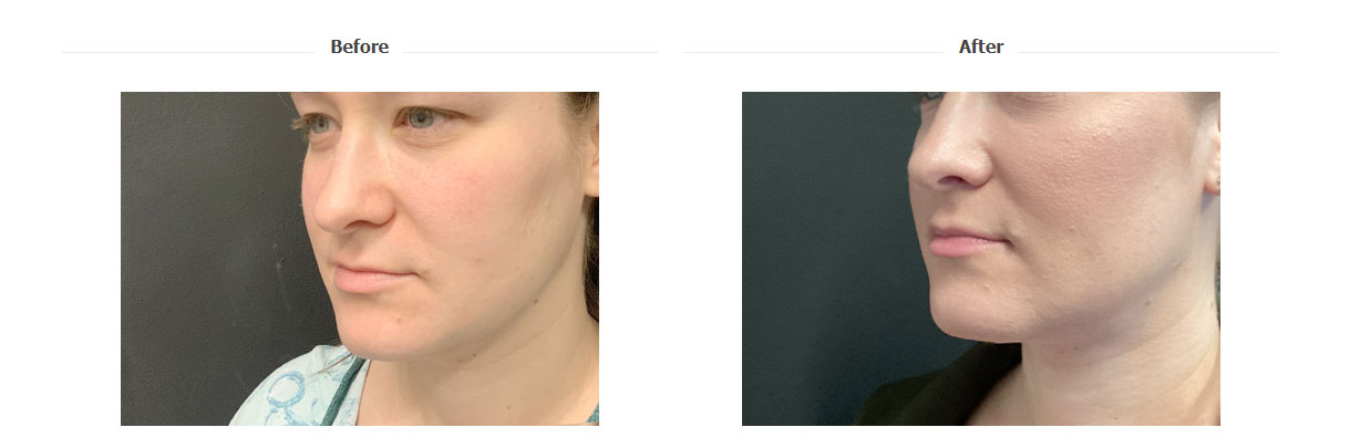 Lower Face Contouring Bellevue And Kirkland